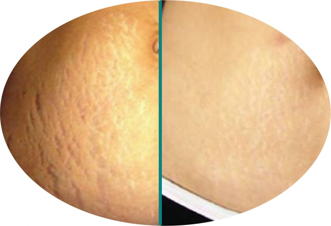 DermaRoller Before & After Results | DermaRoller SA®