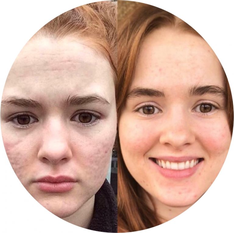 DermaRoller Before & After Results | DermaRoller SA®